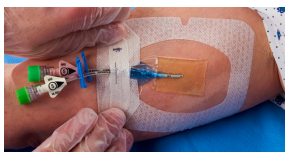 Buy 3M Tegaderm CHG IV Securement Dressings [FSA Approved]