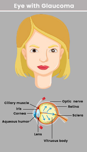 7 Tips On How To Prevent Glaucoma | Glaucoma Prevention